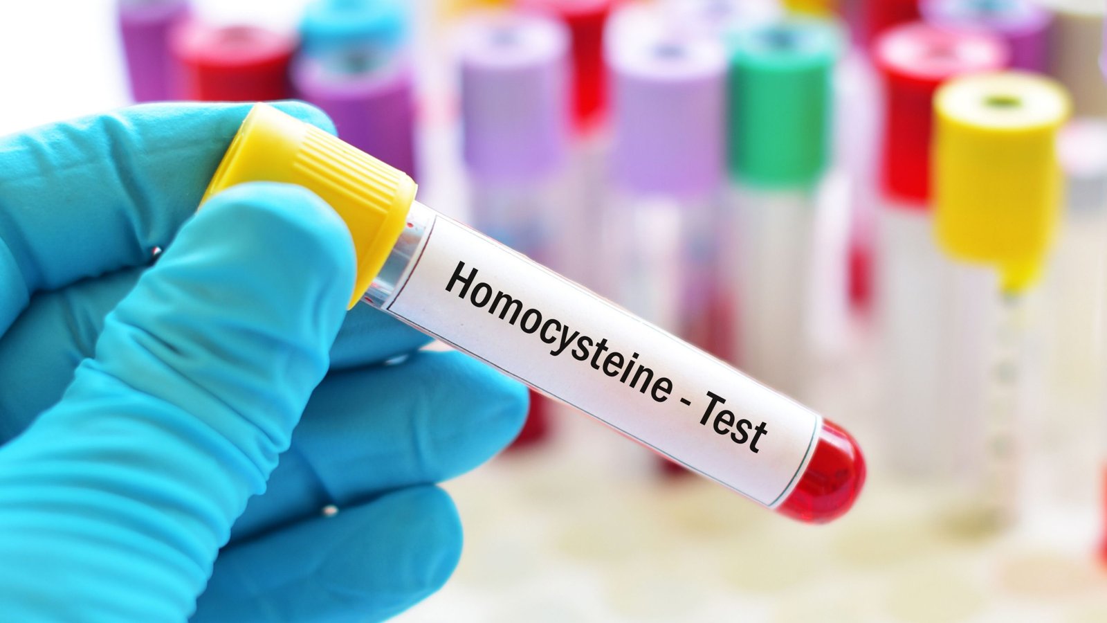 Homocysteine Levels: A Layman's Guide - NuGenomics