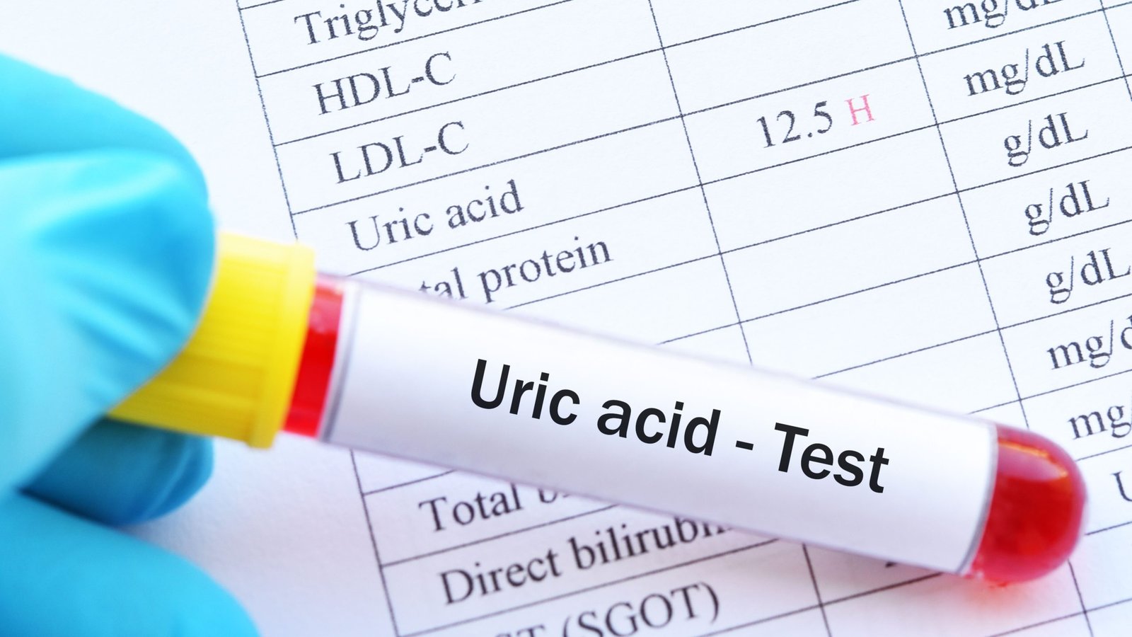 Uric Acid: A Layman’s Guide - NuGenomics